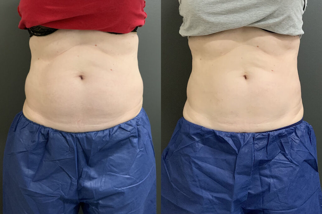 CoolSculpting Photos | Elite Dermatology & Plastic Surgery
