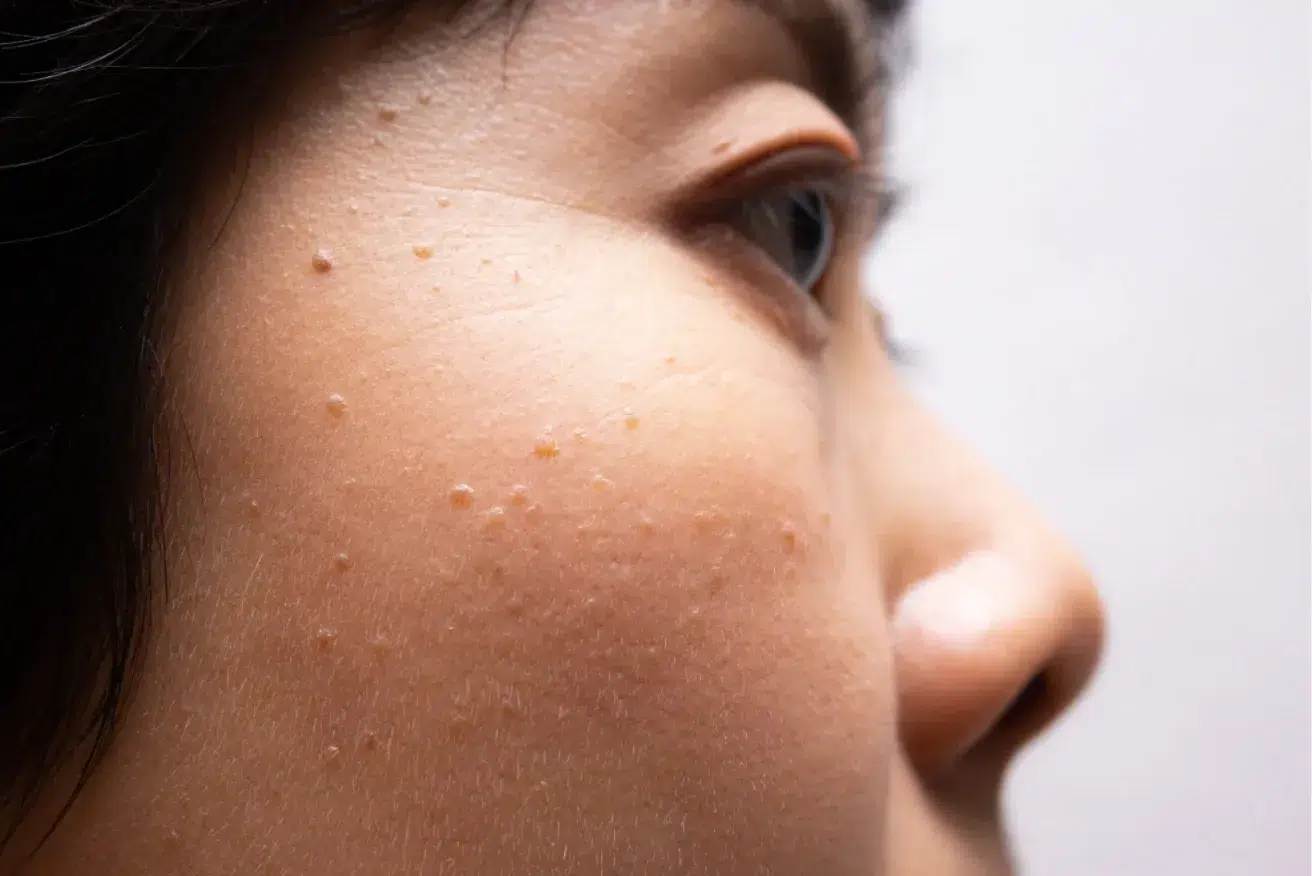 Seborrheic Keratosis Tx Elite Dermatology And Plastic Surgery